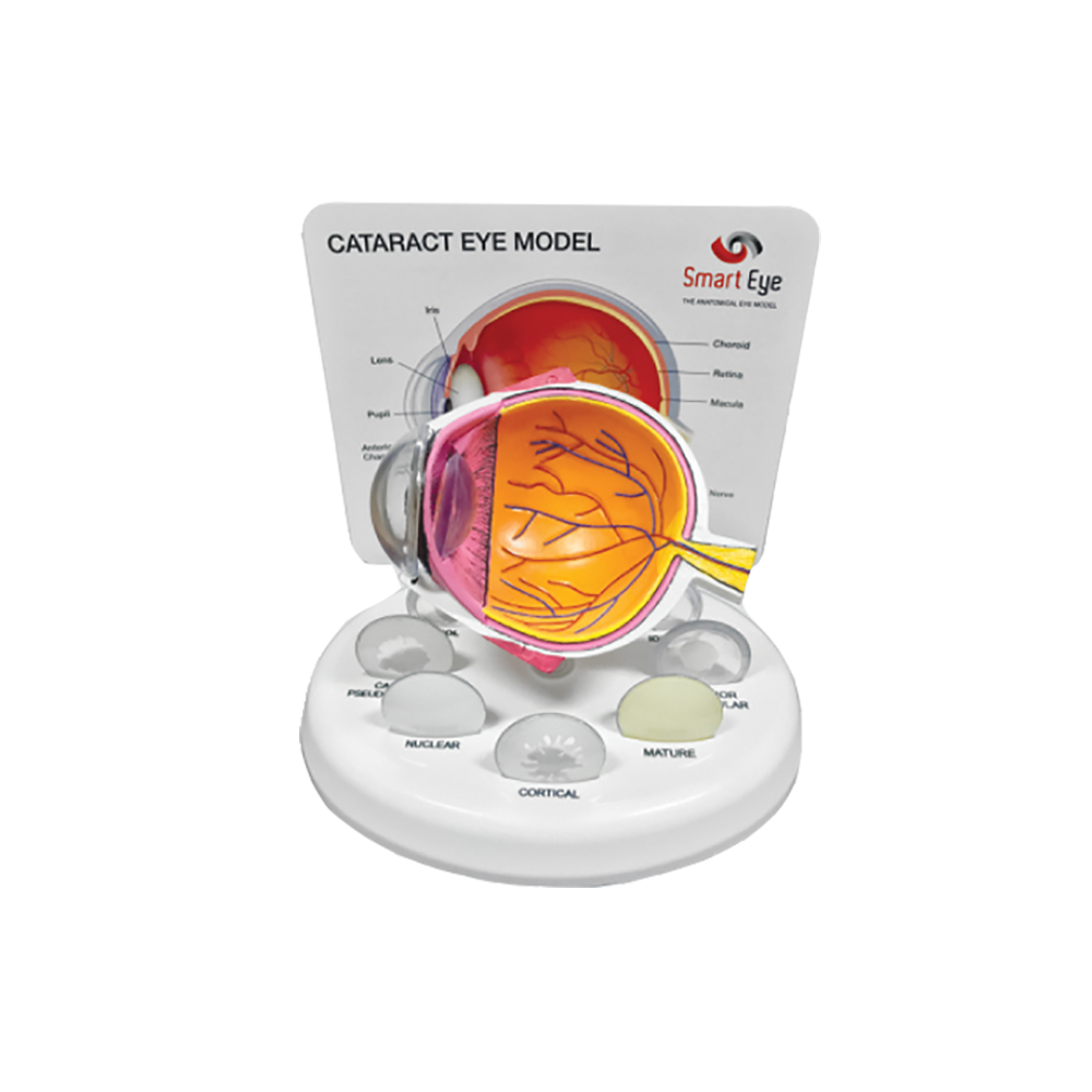 Eye Model - Cataract